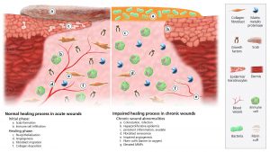 Illustration of chronic wound compared to the acute wound - MedicalGraphics