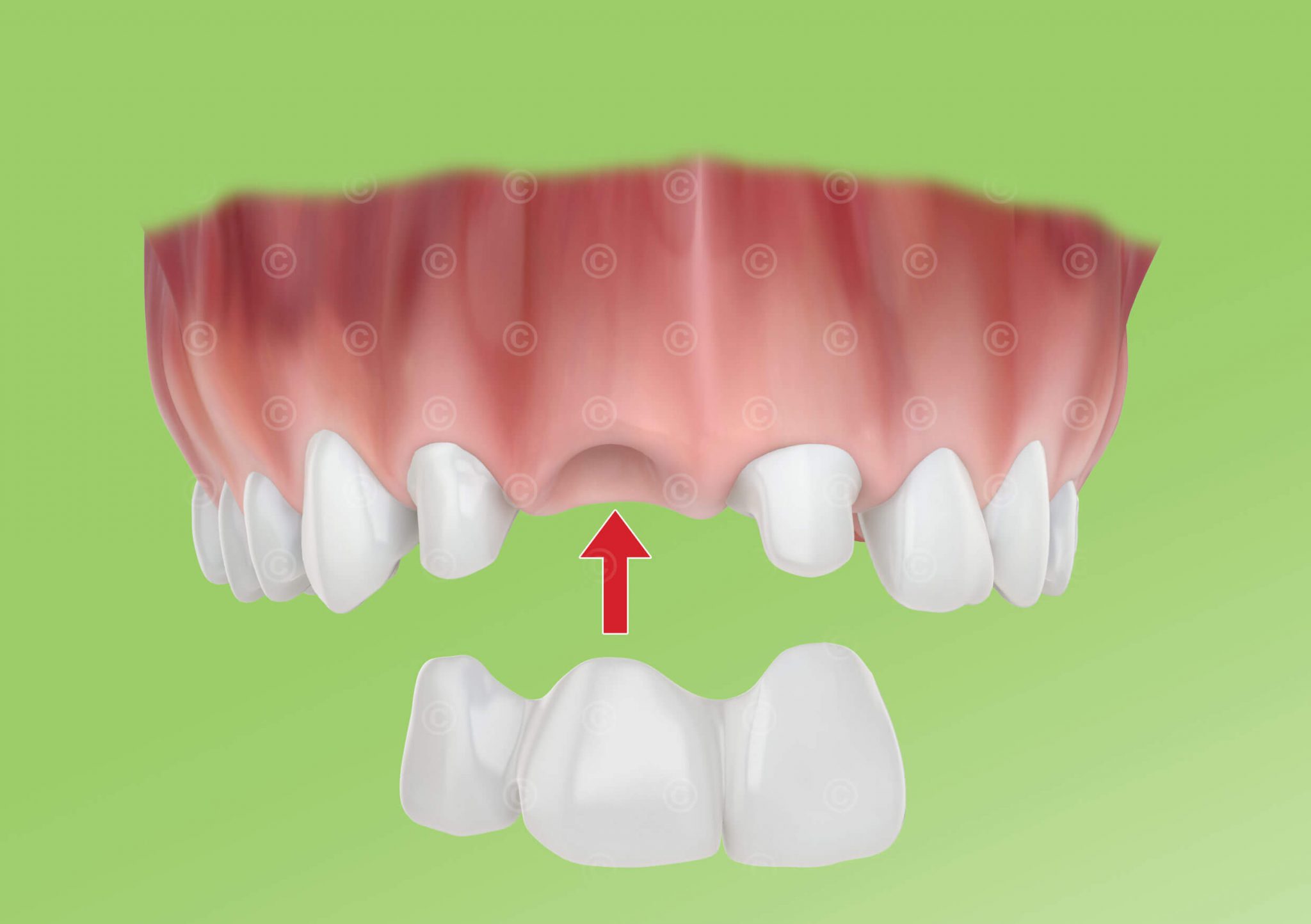 Illustrationen Zahnersatz - MedicalGraphics