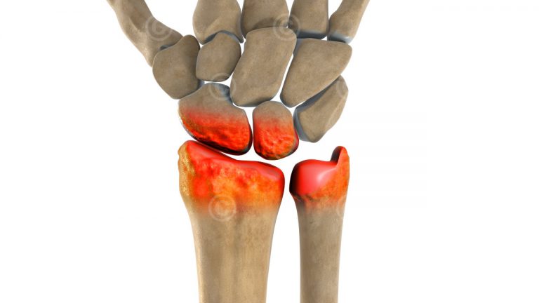 Illustrationen Arthrose der Hand - MedicalGraphics