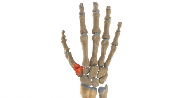 Illustrationen Arthrose der Hand - MedicalGraphics