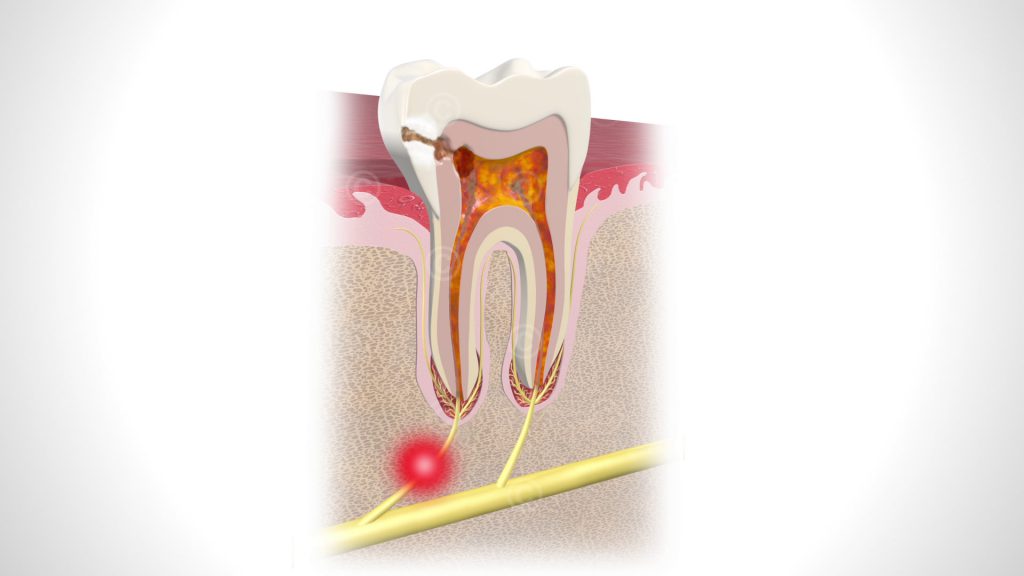 Animations neuropathic pain - MedicalGraphics