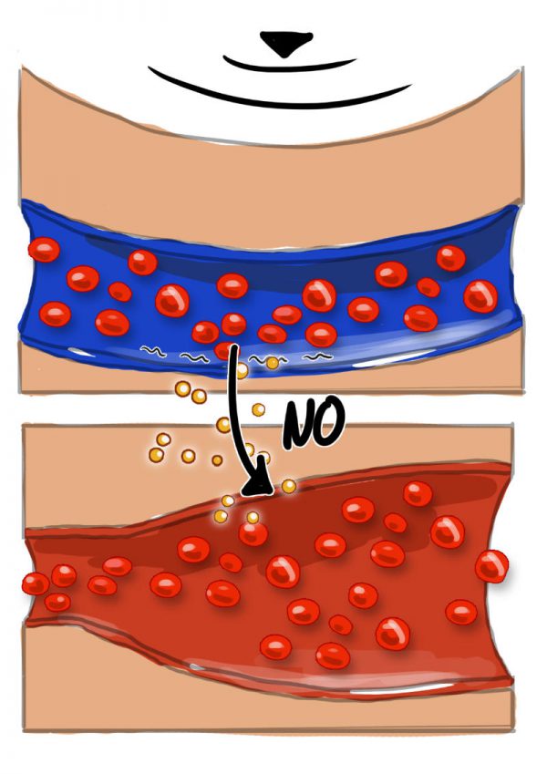 Infographic of compression therapy in vascular disease - MedicalGraphics