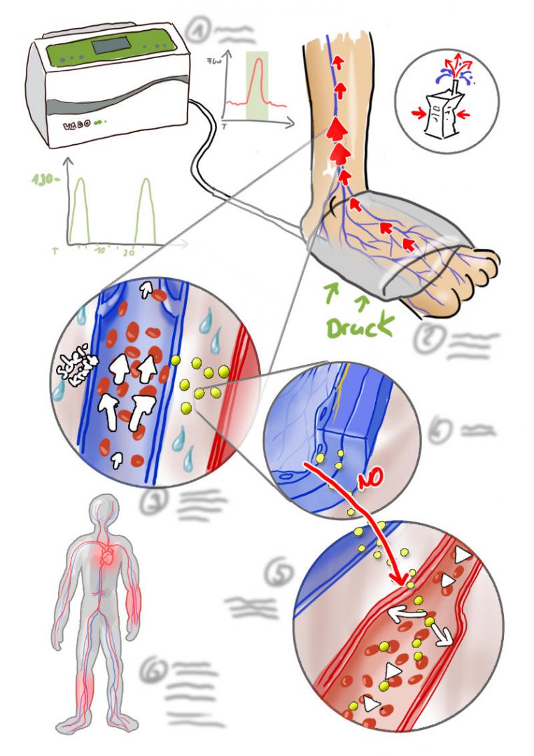 Infografik zu Kompression-Therapie bei Gefäßerkrankungen - MedicalGraphics