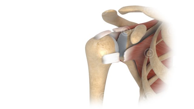 Illustrations injury shoulder - MedicalGraphics