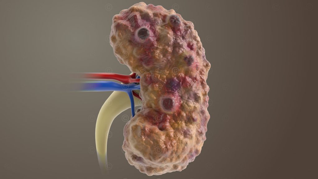 Illustration erkrankte Niere - MedicalGraphics