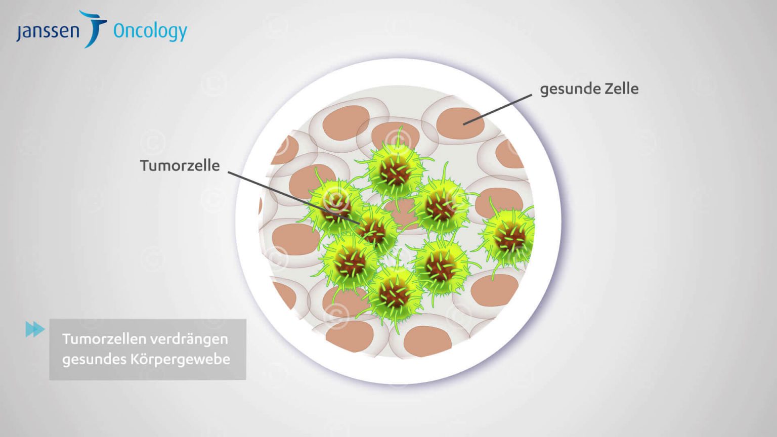2D animated information film on prostate cancer - MedicalGraphics