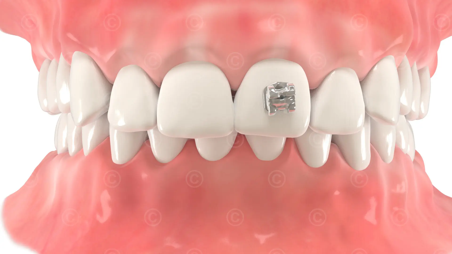 Animations Orthodontics - MedicalGraphics