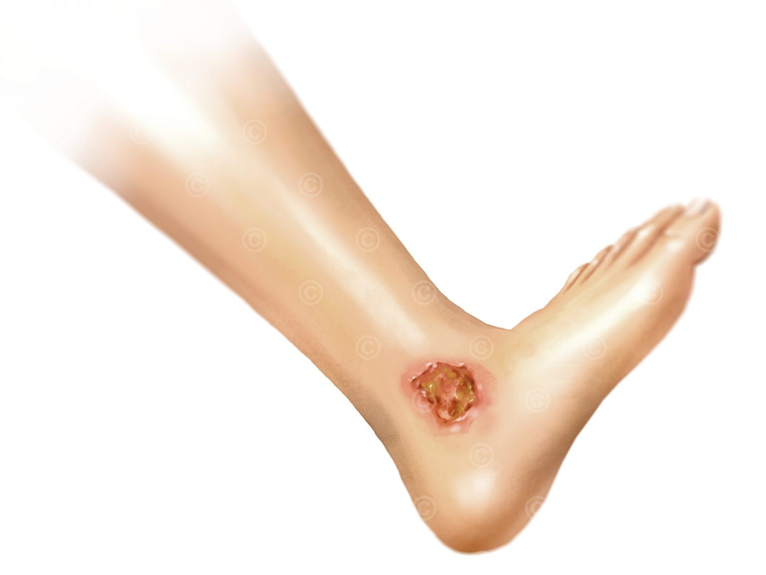 Illustration chronische Wunde Bein - MedicalGraphics