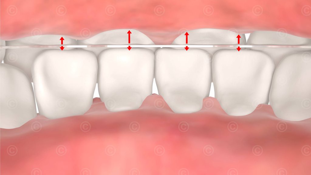 Animations retainer in Orthodontics - MedicalGraphics
