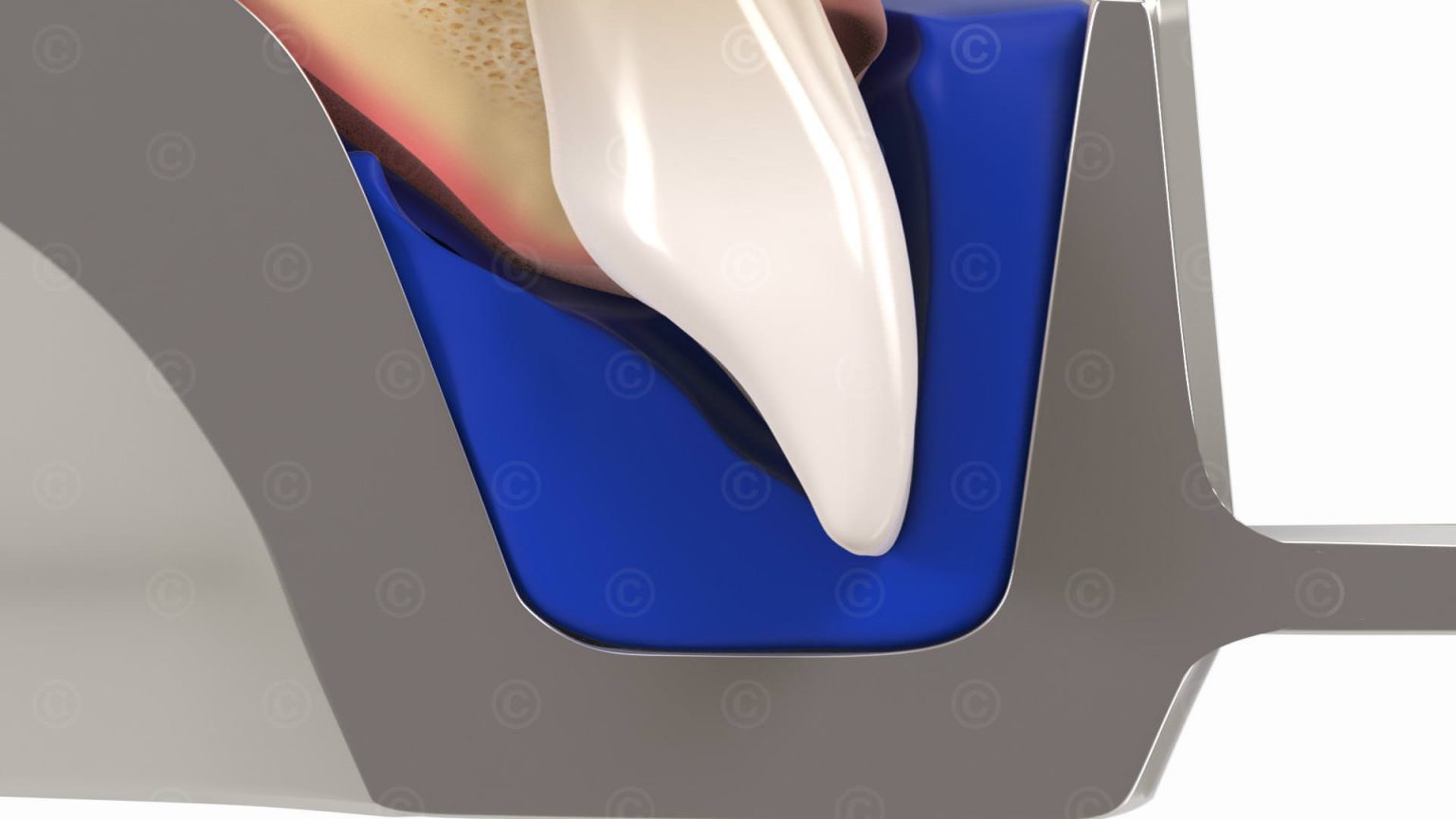 Animations retainer in Orthodontics - MedicalGraphics