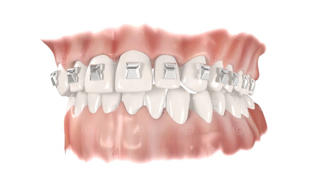 Animation tooth correction with brackets and aligners - MedicalGraphics