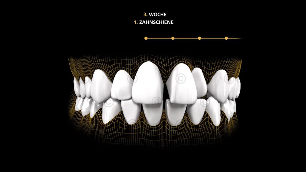 Animations dental splint - MedicalGraphics