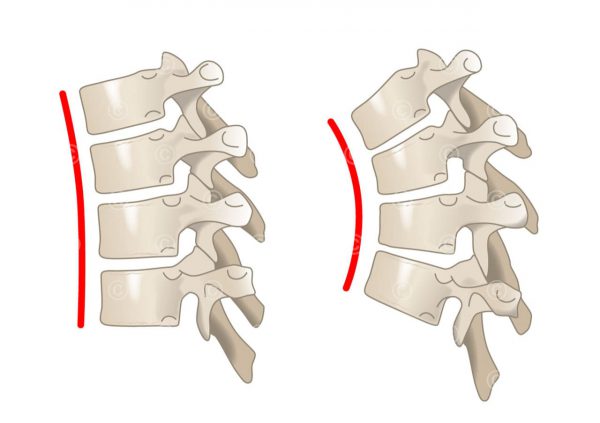 Graphics spinal disease - MedicalGraphics