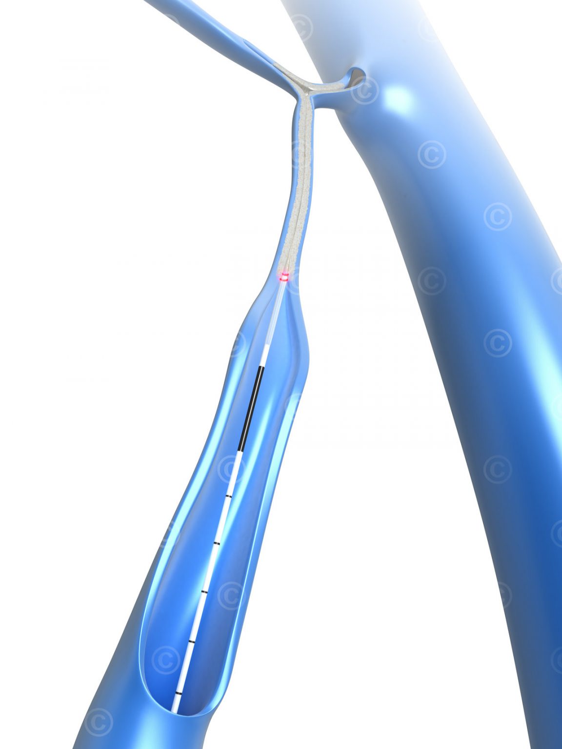 Illustration treatment varicose veins - MedicalGraphics