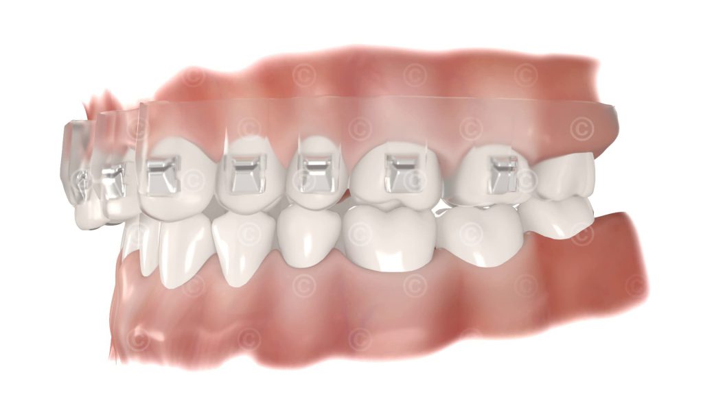 Animation tooth correction with brackets and aligners - MedicalGraphics