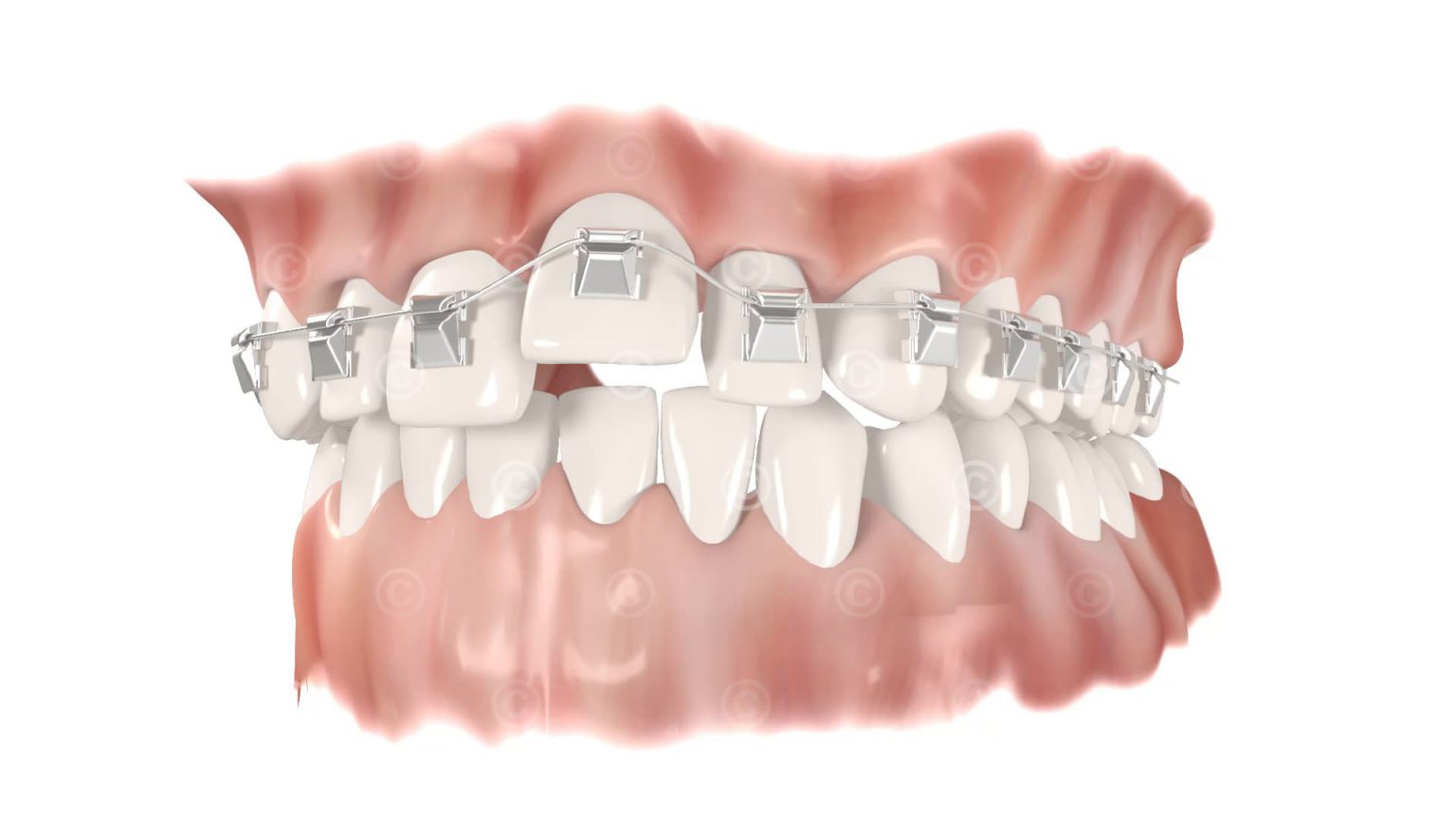 Animation tooth correction with brackets and aligners - MedicalGraphics