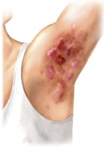 Drawn medical illustrations - acne inversa - MedicalGraphics