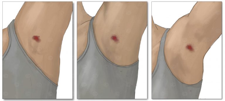 Drawn medical illustrations - acne inversa - MedicalGraphics