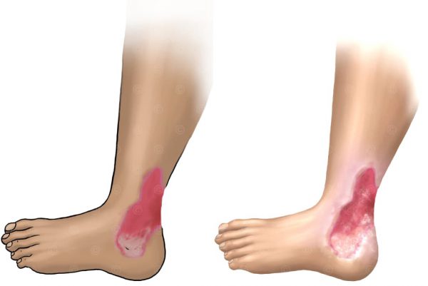 Illustrationen Wunden - MedicalGraphics