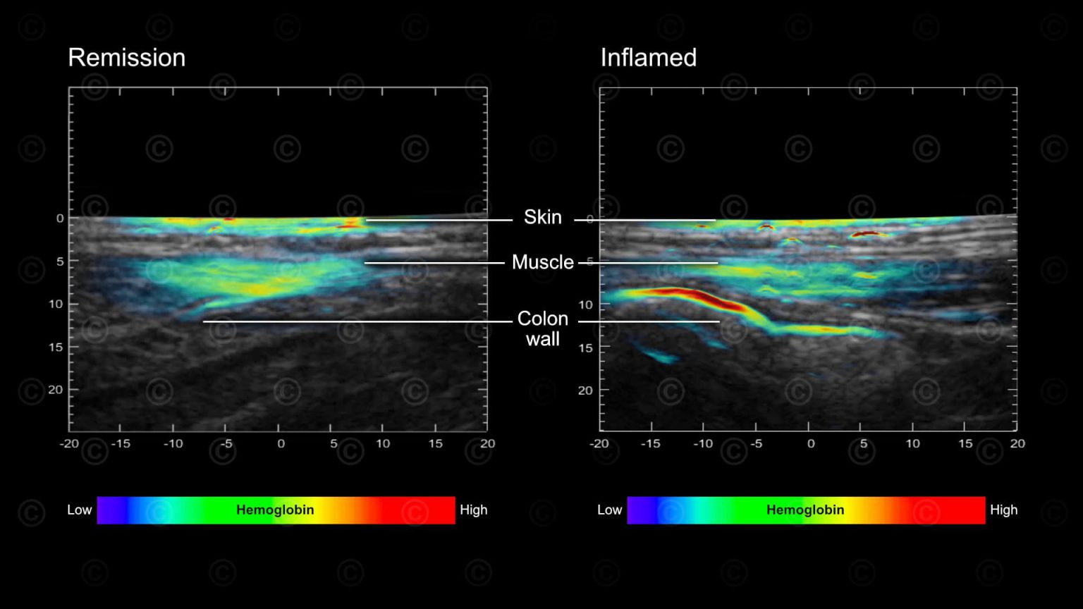 Animation monitoring inflammatory bowel diseases - MedicalGraphics