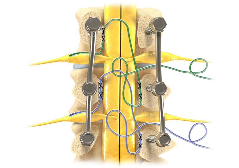 Illustrations DRG stimulation - MedicalGraphics