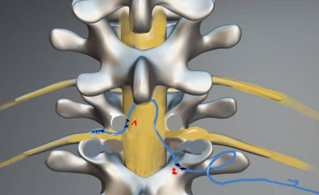 Illustrations DRG stimulation - MedicalGraphics