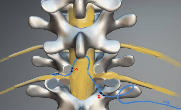 Illustrations DRG stimulation - MedicalGraphics