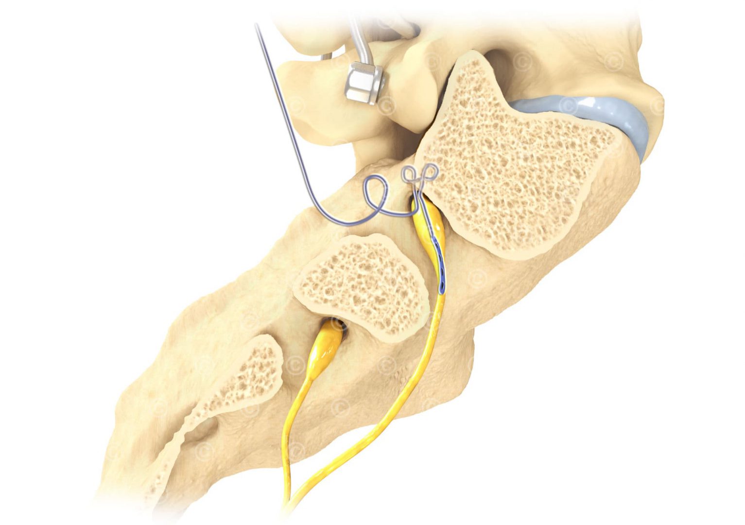 Illustrations DRG stimulation - MedicalGraphics