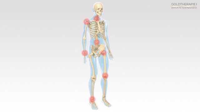3D animation gold implantation - MedicalGraphics