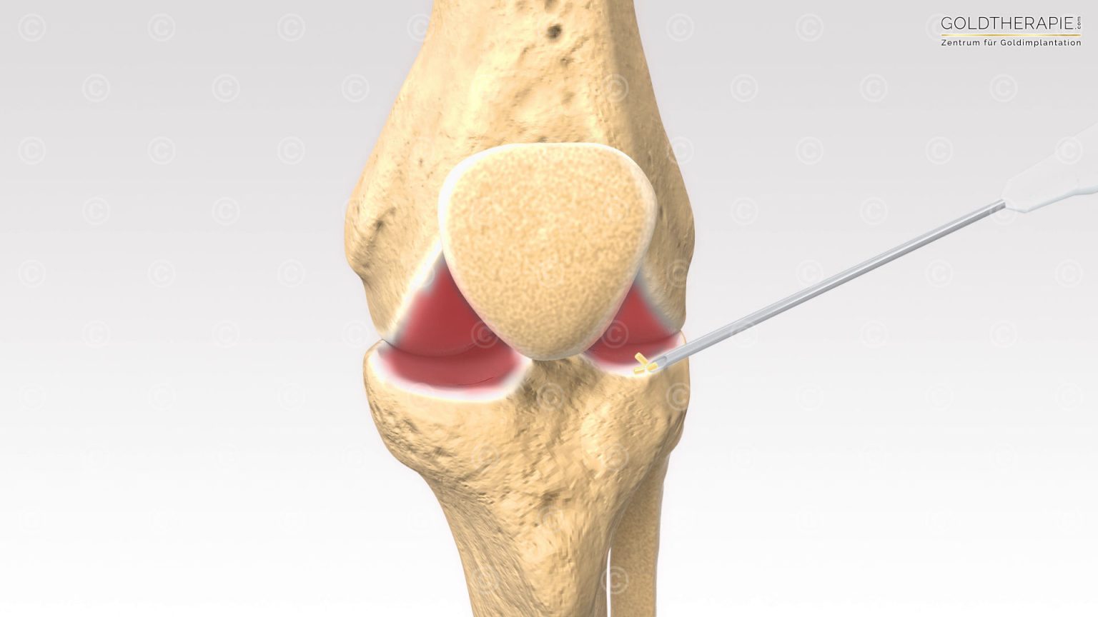 3D animation gold implantation - MedicalGraphics
