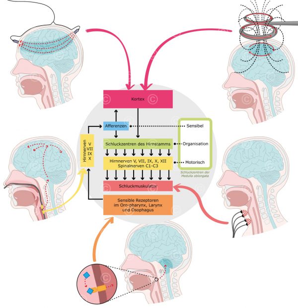 Illustrationen Dysphagie MedicalGraphics Illustrationen Dysphagie MedicalGraphics