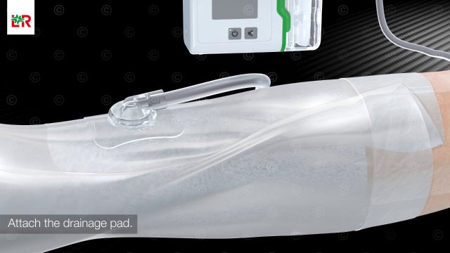 Animation negative pressure therapy wounds - MedicalGraphics