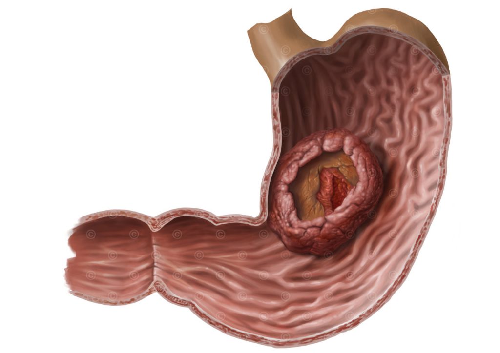 Illustrations diseases - MedicalGraphics