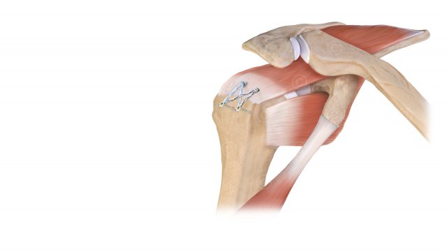 Illustrations surgical instructions rotator cuff - MedicalGraphics