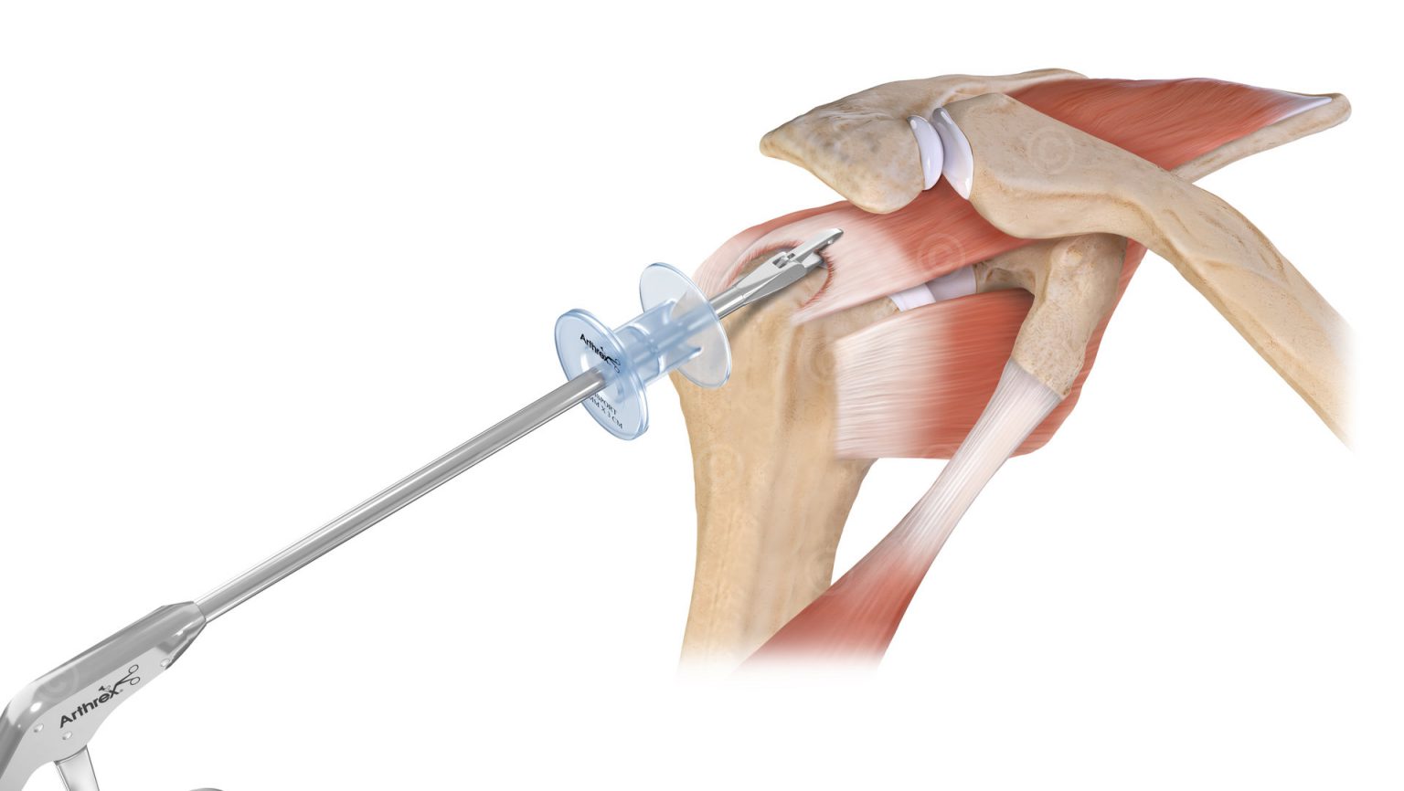 Illustrations surgical instructions rotator cuff - MedicalGraphics