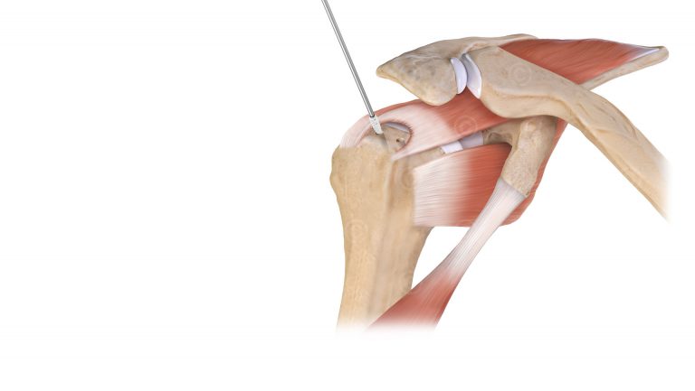 Illustrations surgical instructions rotator cuff - MedicalGraphics