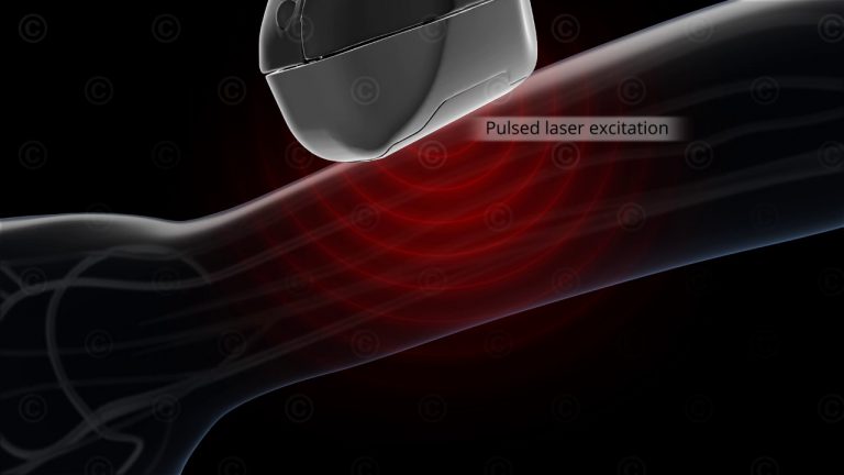 Optoacoustic imaging animation - MedicalGraphics