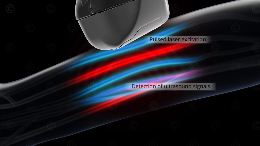 Optoacoustic imaging - 3D animation - MedicalGraphics