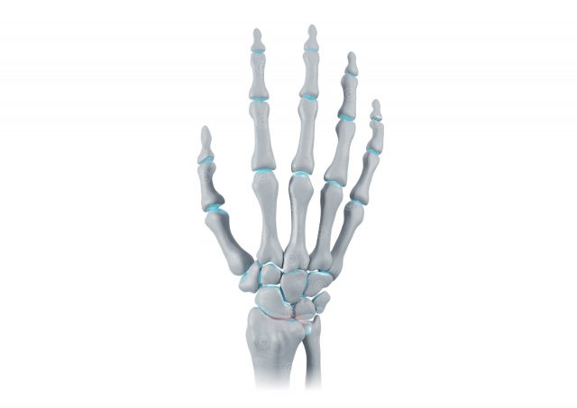 Illustrationen Handgelenksarthrose - MedicalGraphics