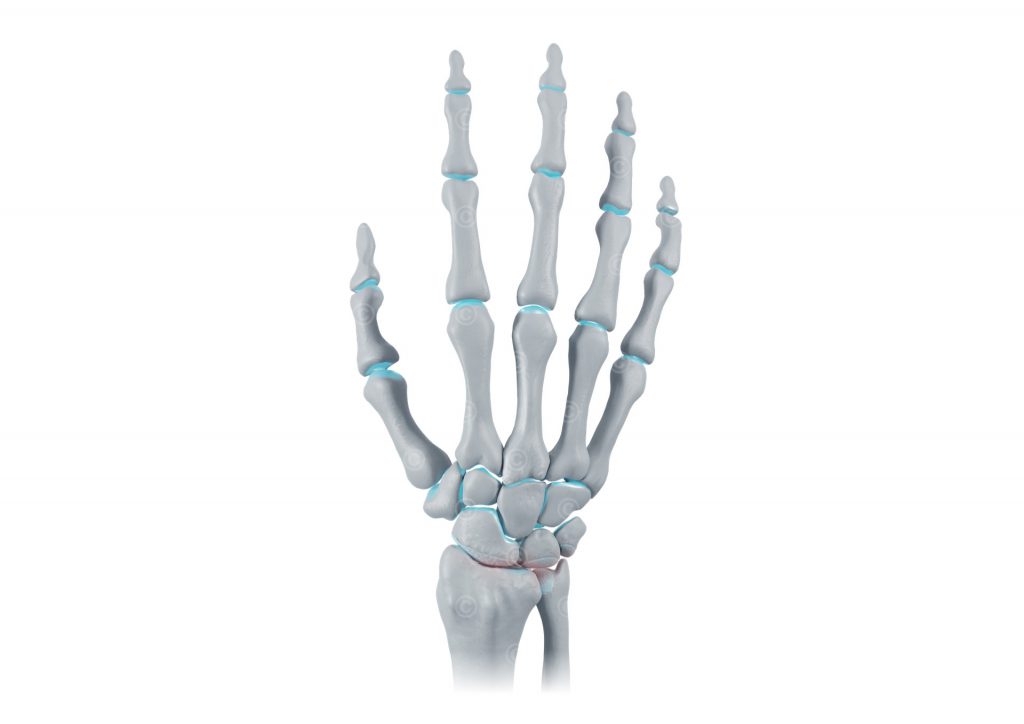 Illustrationen Handgelenksarthrose - MedicalGraphics