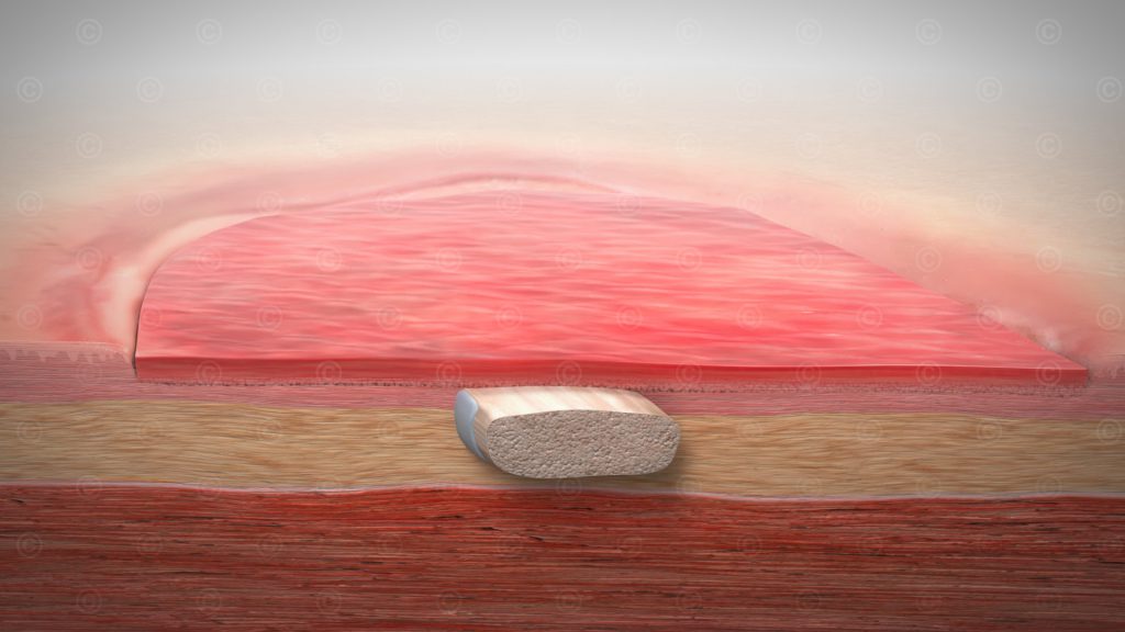 Animation skin replacement fish skin - MedicalGraphics