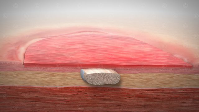 Animation skin replacement fish skin - MedicalGraphics