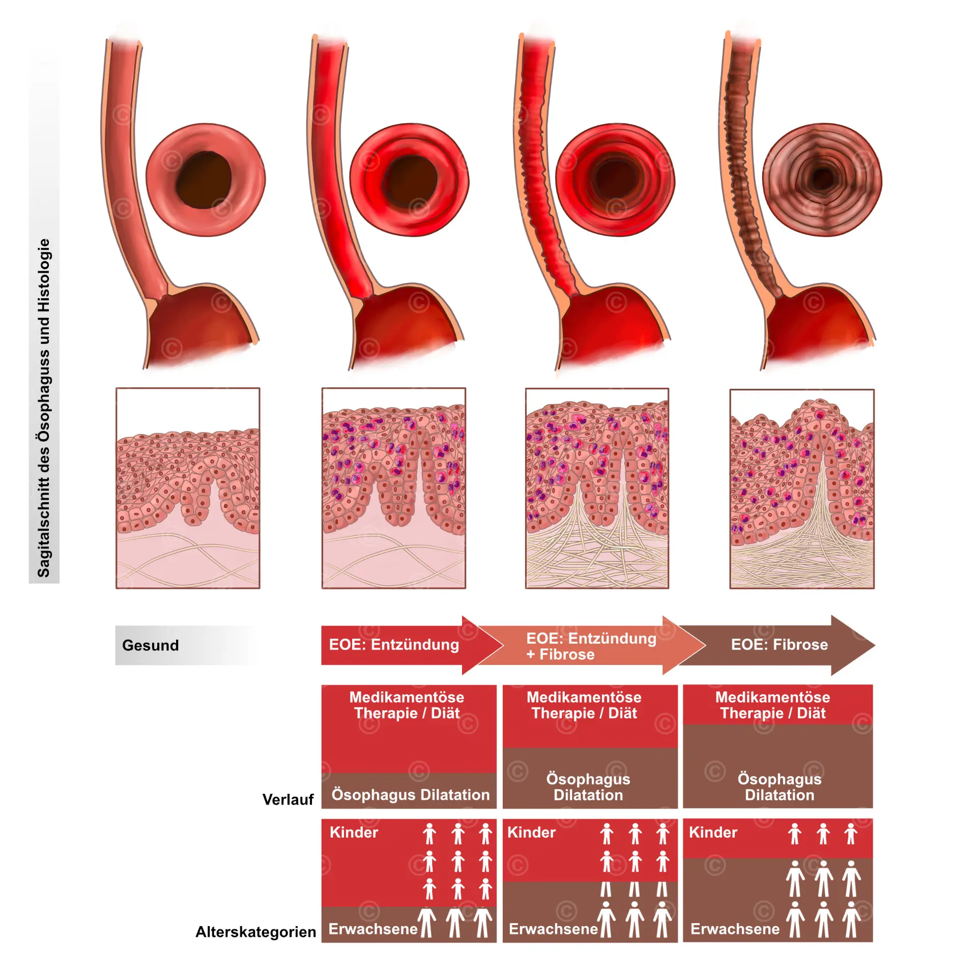 Eosinophile Ösophagitis - MedicalGraphics