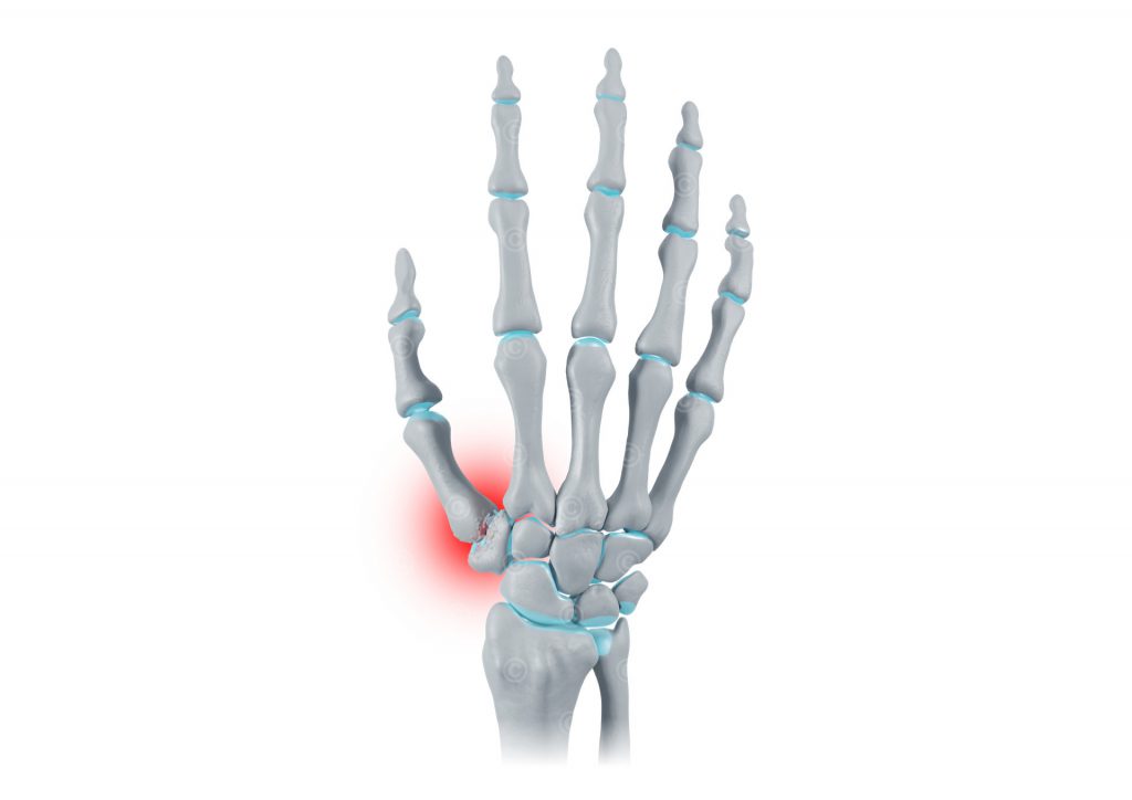 Illustration Rhizarthrosis - MedicalGraphics