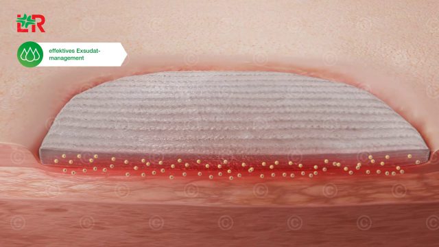 Animation wound dressing Suprasorb A Pro - MedicalGraphics