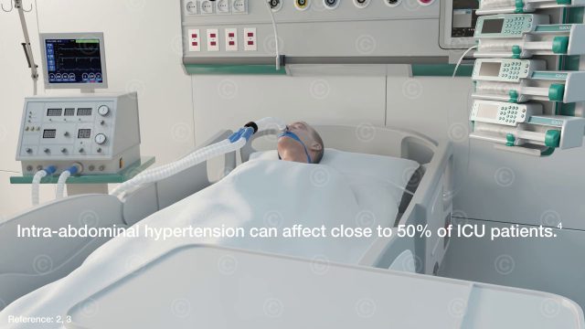 Animation intraabdominal pressure - MedicalGraphics