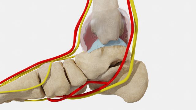 App hemophilic arthropathy - MedicalGraphics