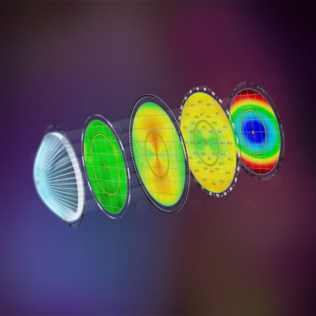Keyvisuals Astigmatismus und Keratokonus - MedicalGraphics