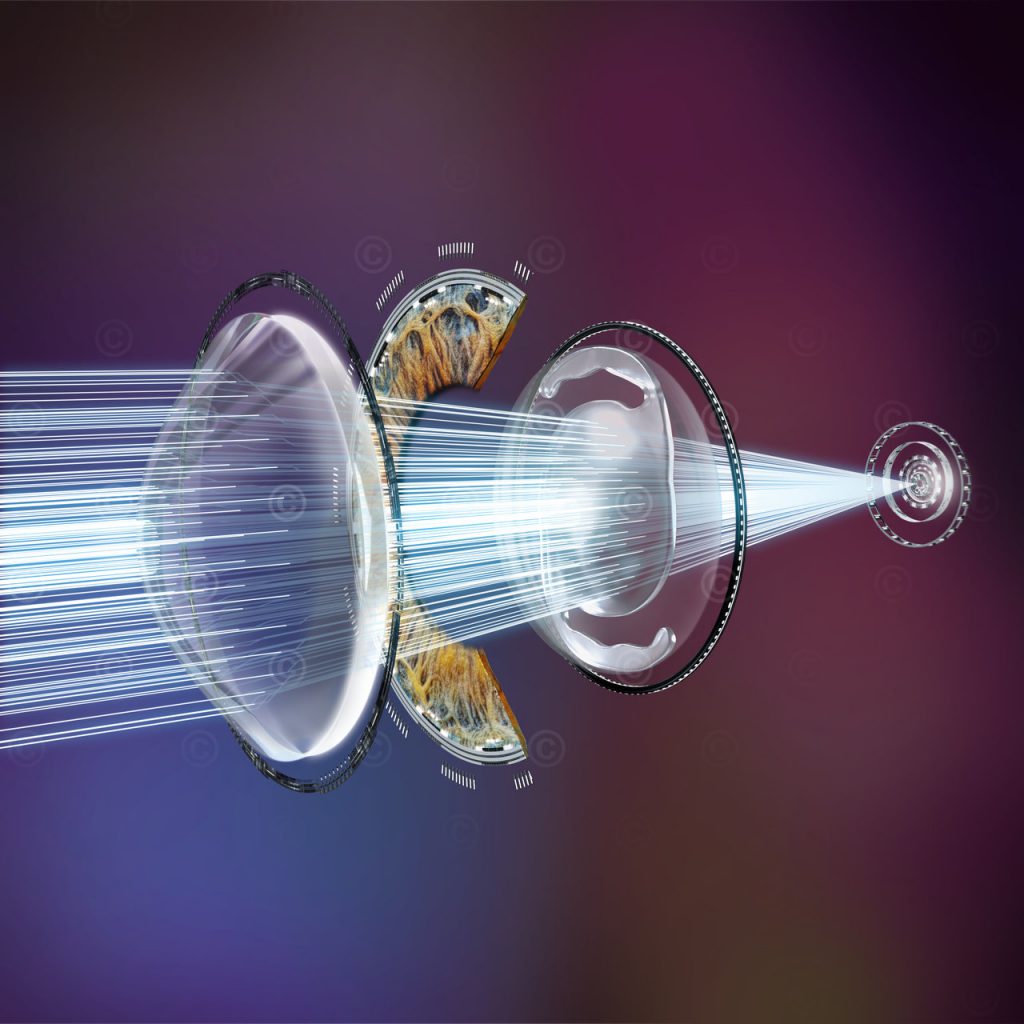 Keyvisuals Astigmatismus und Keratokonus - MedicalGraphics