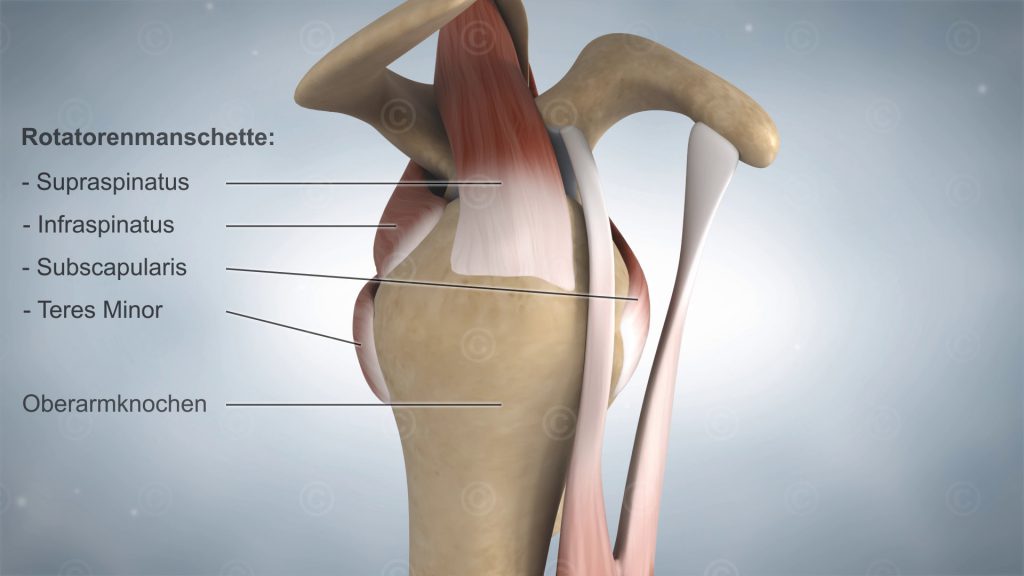 Animation rupture rotator cuff - MedicalGraphics